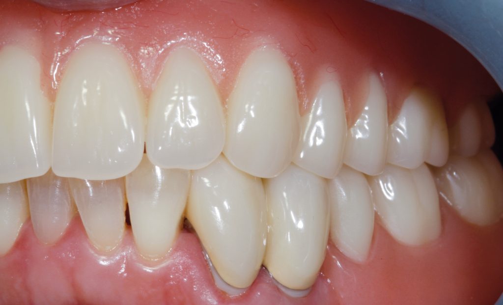 Phonares II - dentureshop