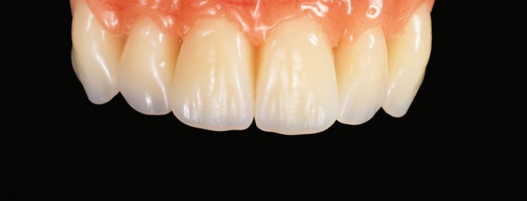 Phonares II SOFT - dentureshop